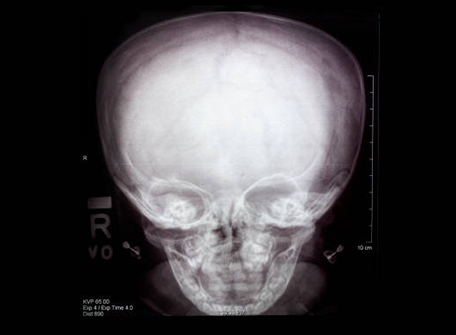 Baby Helmet Therapy | Head Deformity | Hope AMC